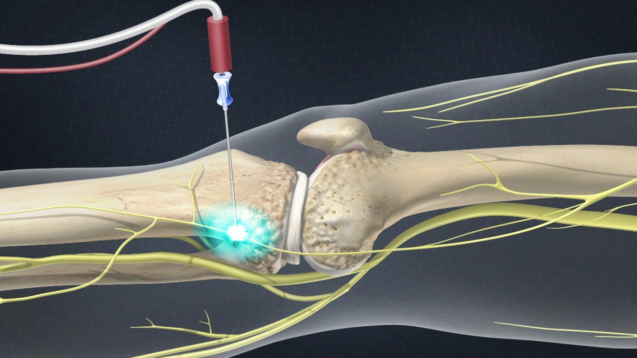 Radio Frequency Ablation RFA Cost Medicare Trials At USA