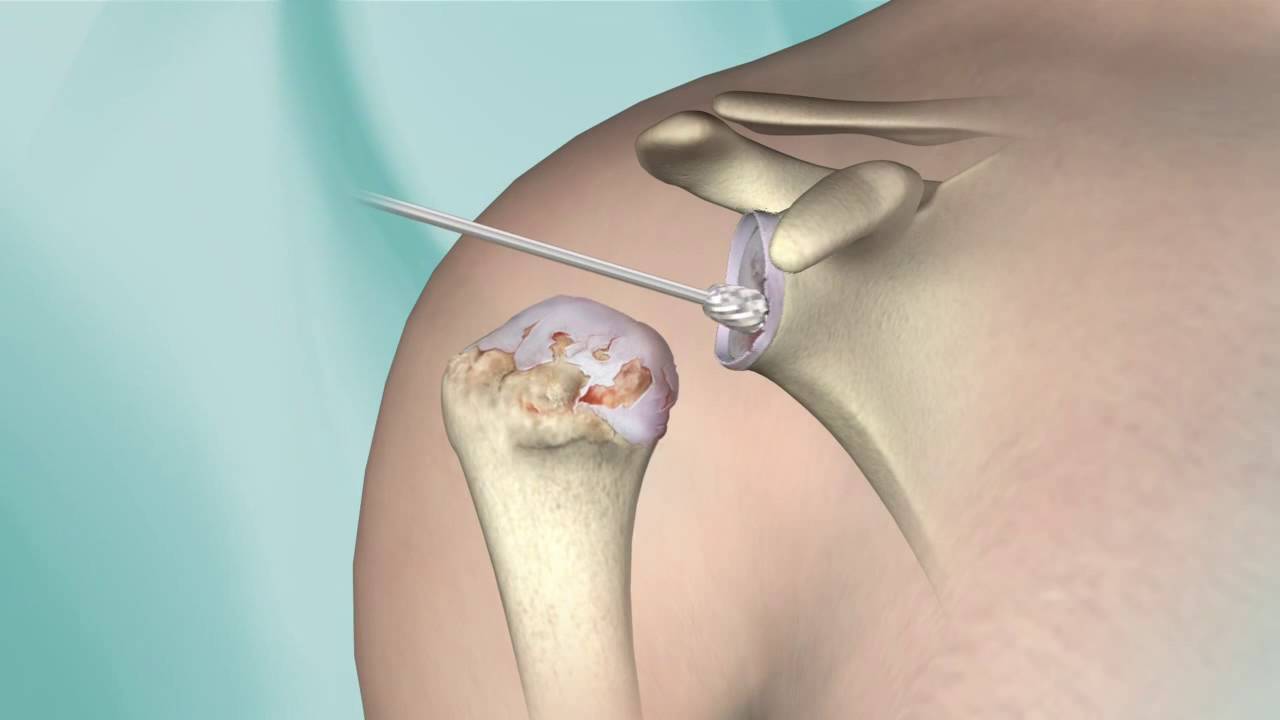 Resurfacing Hemiarthroplasty Shoulder USA Spine Care Orthopedics