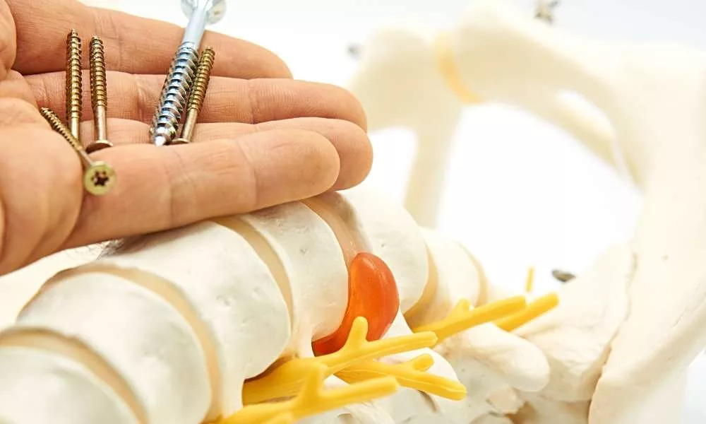 Living with a Spinal Implant: Long-Term Considerations and Maintenance ...