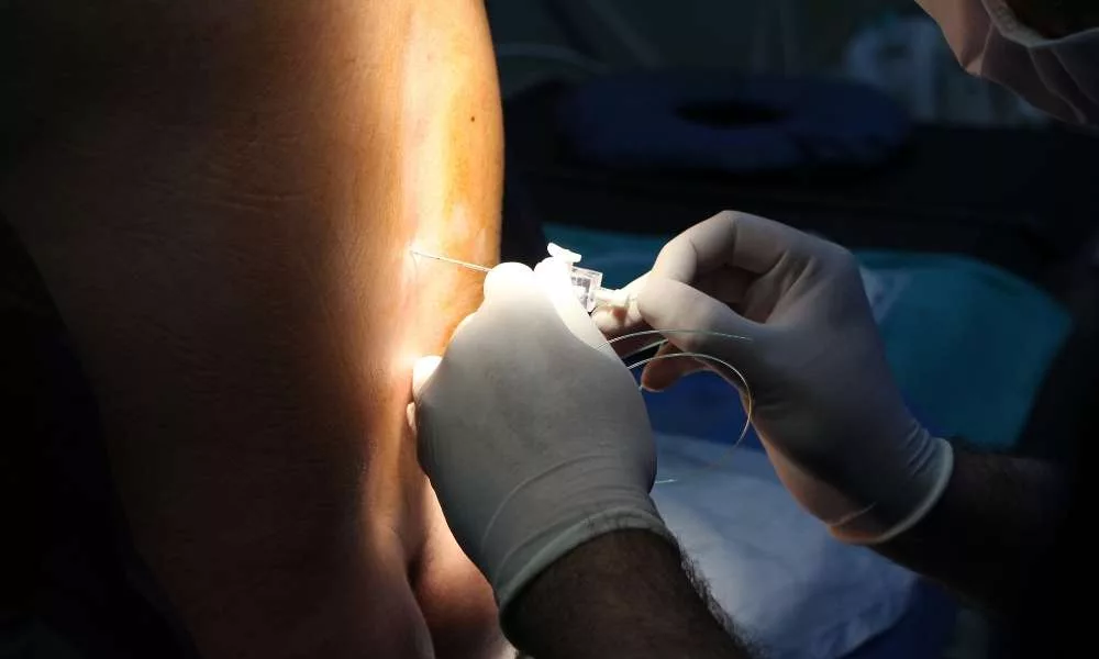 Comparing the Cost of BESS to Traditional Open Spine Surgery - USA ...