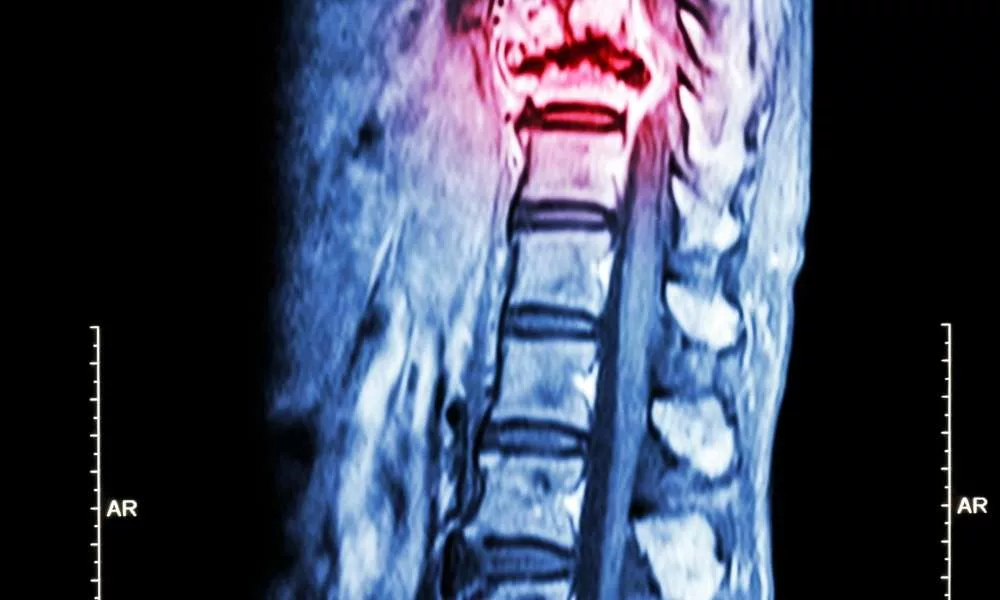 Managing Pain Associated with Syringomyelia - USA Spine Care - Laser ...